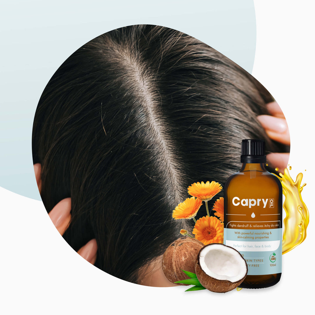 Beat dandruff & relieve itchy dry skin with Capry Oil – Capry Ltd